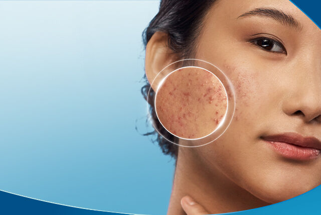 Cleansers and Moisturizers for Oily & Acne-prone Skin | Cetaphil Singapore